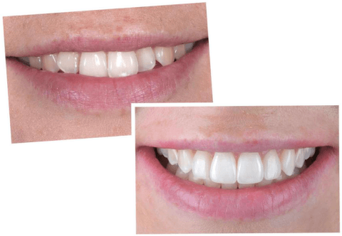 Teeth Straightening - Kingsport Dental Practice | Howden, Livingston